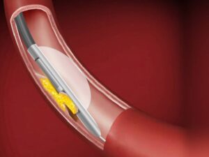 Rotational Atherectomy Theropy in Pune | Dr. Kartik Bhosale