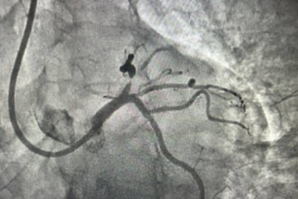 Successful removal of Blockage through Angioplasty from the wrist (Rt ...