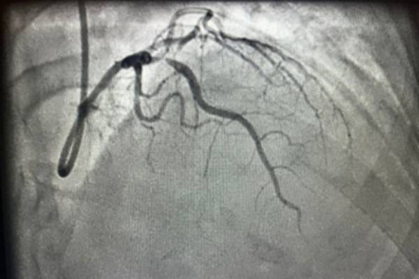 Successful removal of Blockage through Angioplasty from the wrist (Rt ...