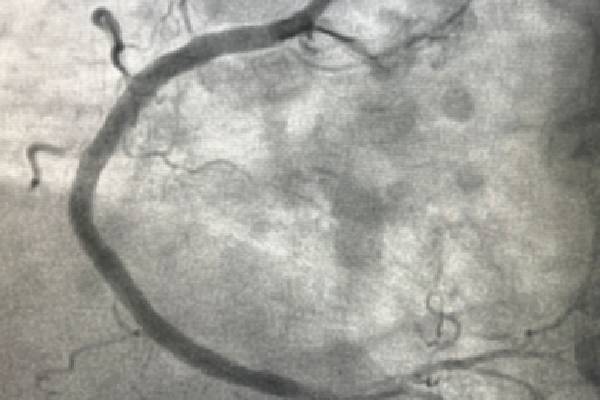 Successful Angioplasty for 90% Blockage in Heart Vessel - Dr. Kartik ...